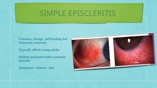 scleritis and episcleritis powerpoint for reading | PPTX