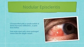 scleritis and episcleritis powerpoint for reading | PPT