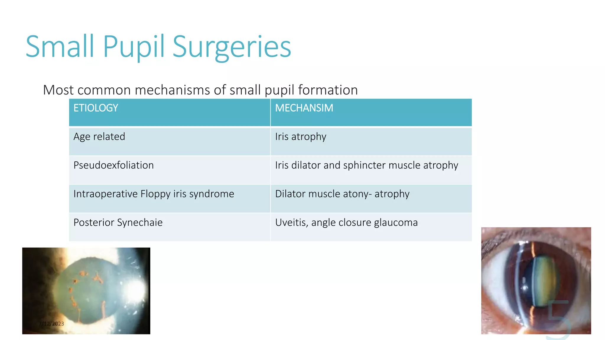 Complex cases in Cataract surgery and its management.pptx