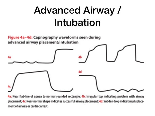 Capnography in emergency room
