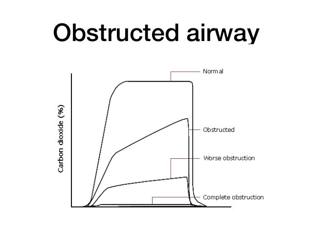 Capnography in emergency room