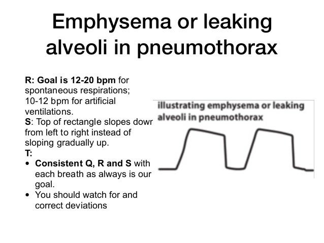 Capnography in emergency room