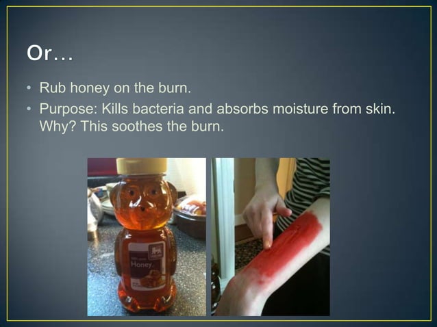 First Aid Presentation: Minor Burn and Moderate Road Rash | PPT