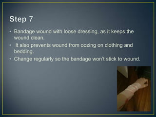 First Aid Presentation: Minor Burn and Moderate Road Rash | PPTX