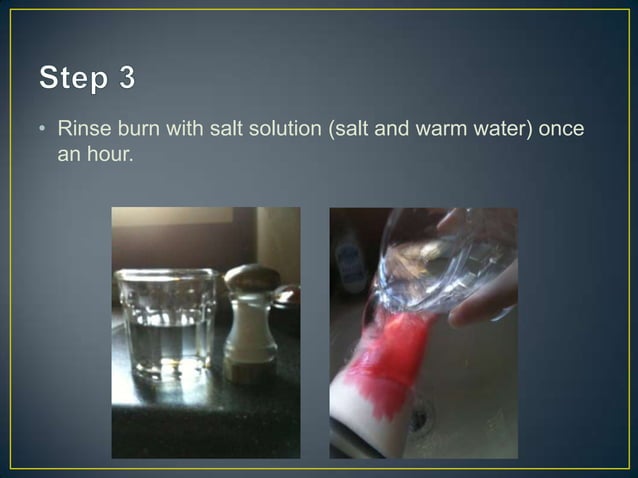 First Aid Presentation: Minor Burn and Moderate Road Rash | PPT