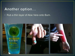 First Aid Presentation: Minor Burn and Moderate Road Rash | PPTX