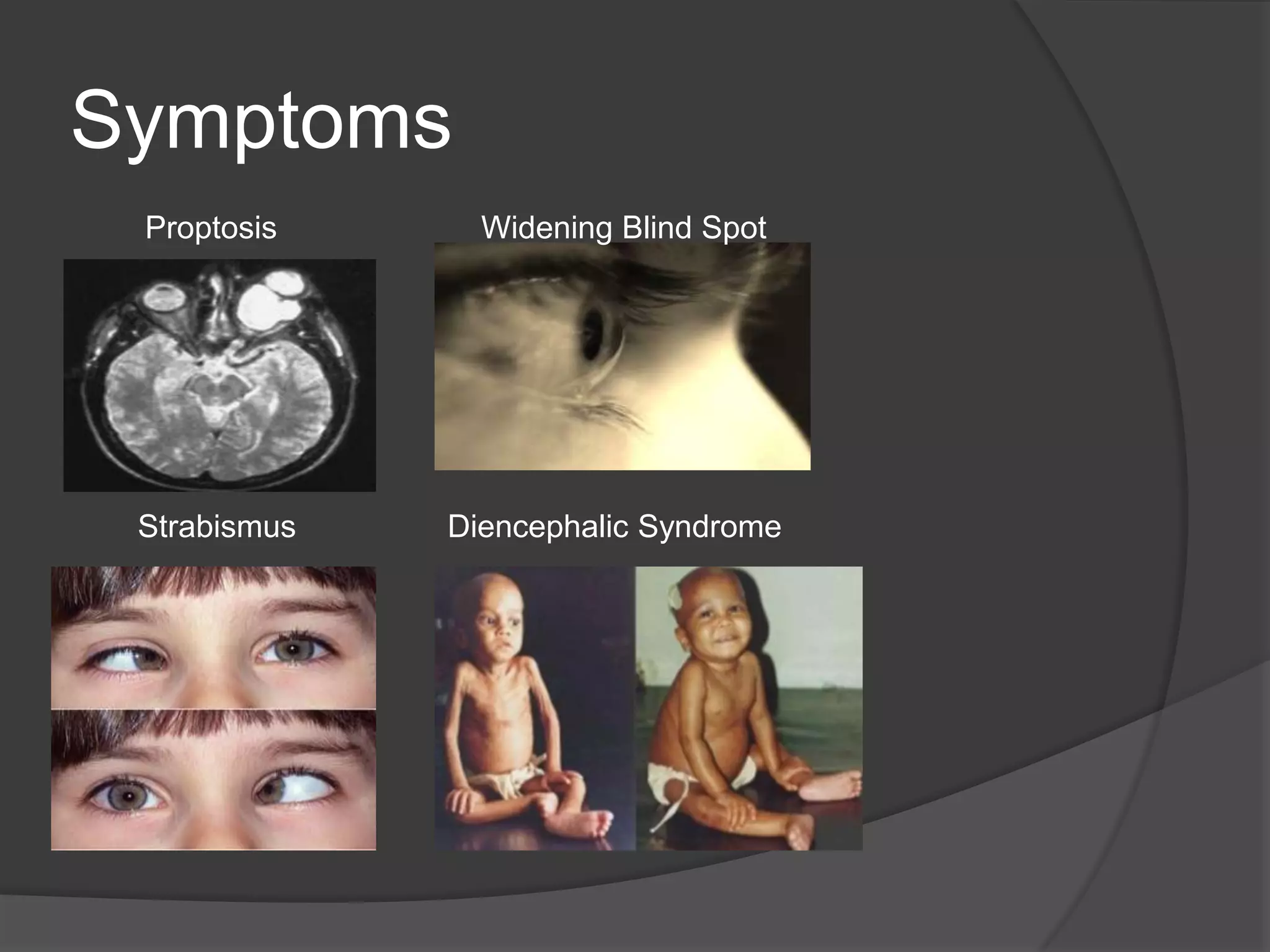 Optic Pathway Gliomas Pptx Brain And Nervous System Disorders Diseases And Conditions