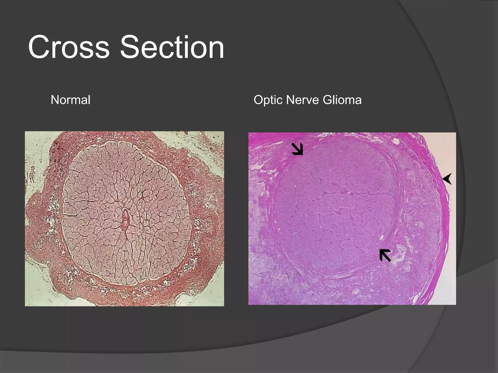 Optic Pathway Gliomas | PPTX
