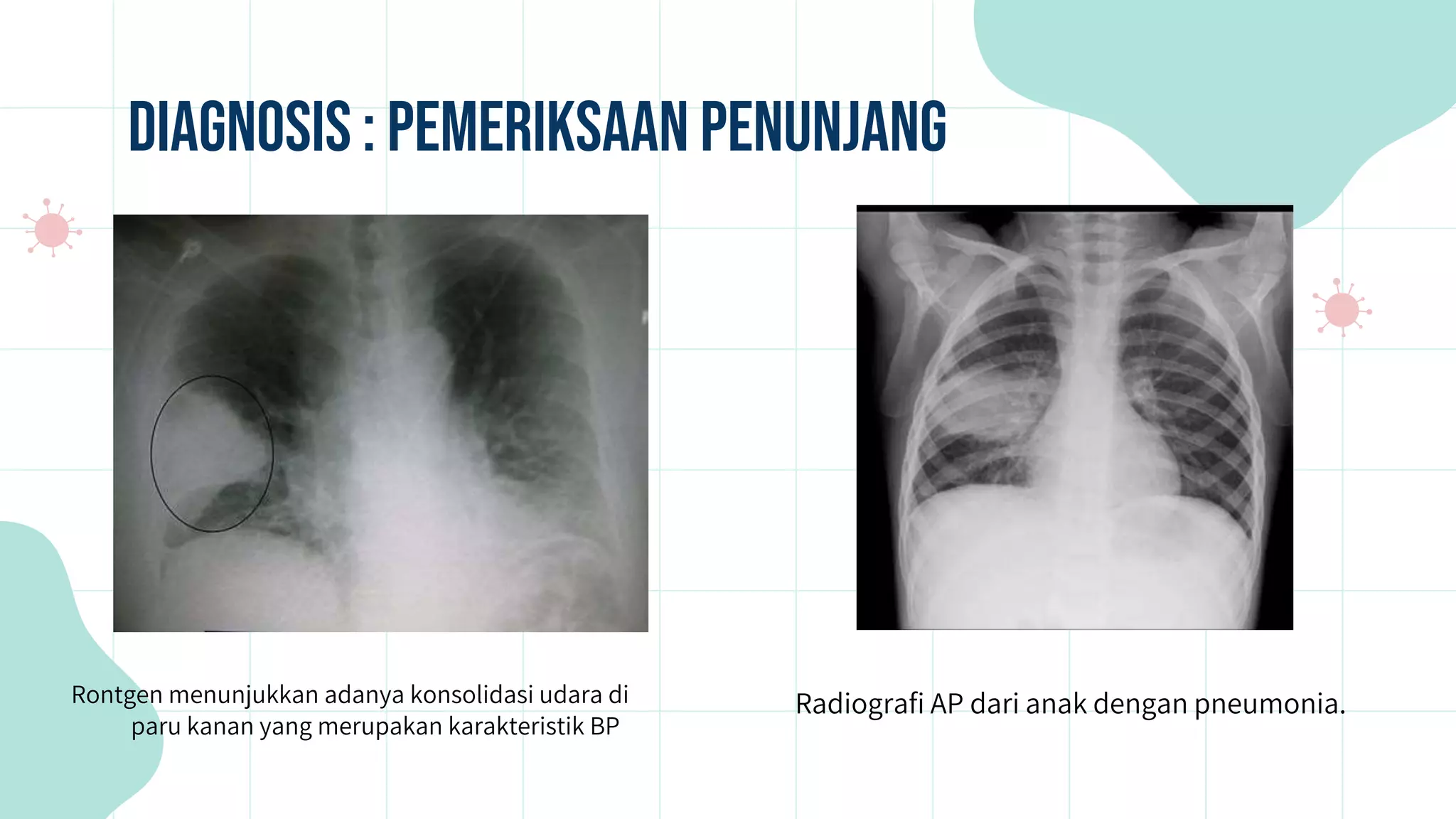 Laporan Kasus Bronkopneumonia Aulia Dwi Juanita.pptx