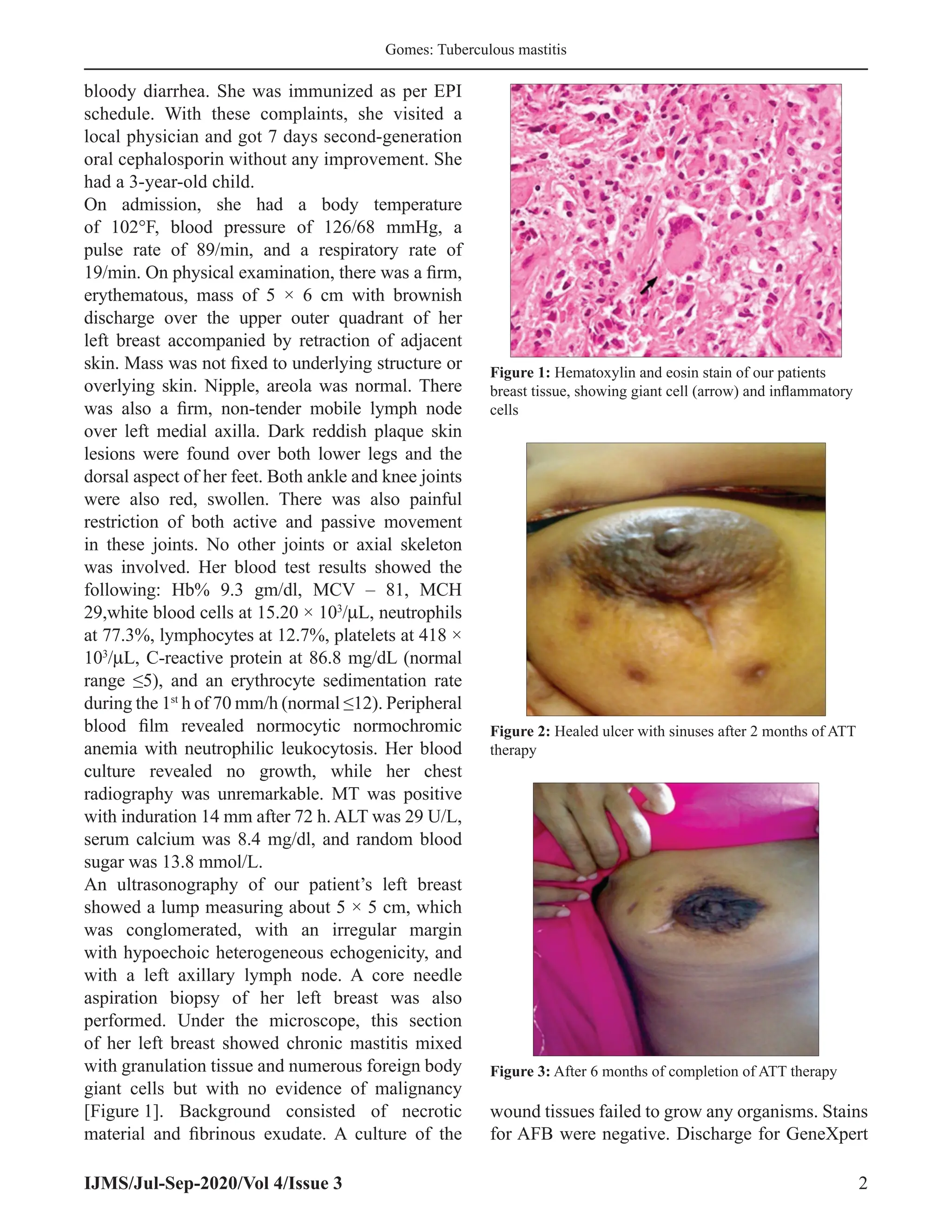 A rare case of tuberculous mastitis mimicking breast carcinoma | PDF | Blood Disorders ...