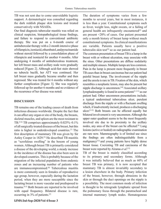 A rare case of tuberculous mastitis mimicking breast carcinoma | PDF