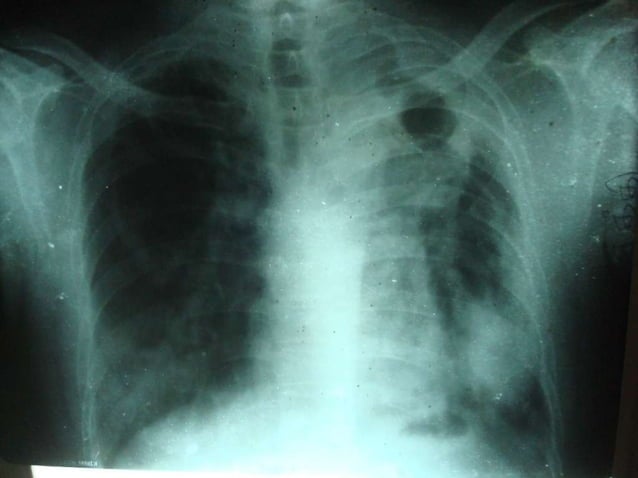 CXR: Multiple Cavities | PPT | Lung and Respiratory Health | Diseases ...