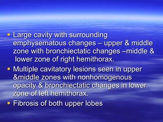 CXR: Multiple Cavities | PPT