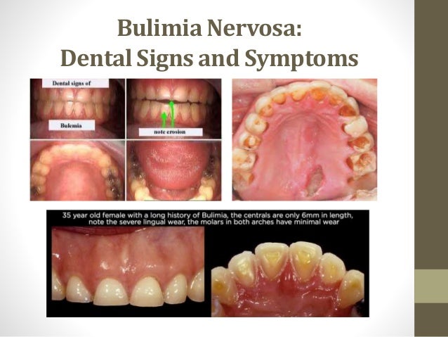 Eating Disorders for Dental Professionals