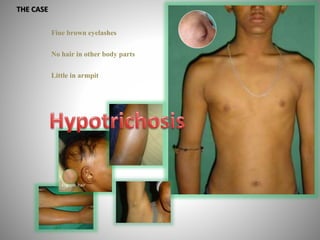 Ectodermal Dysplasia: a case report and overview | PPTX