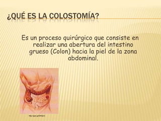 Educación colostomía | PPTX