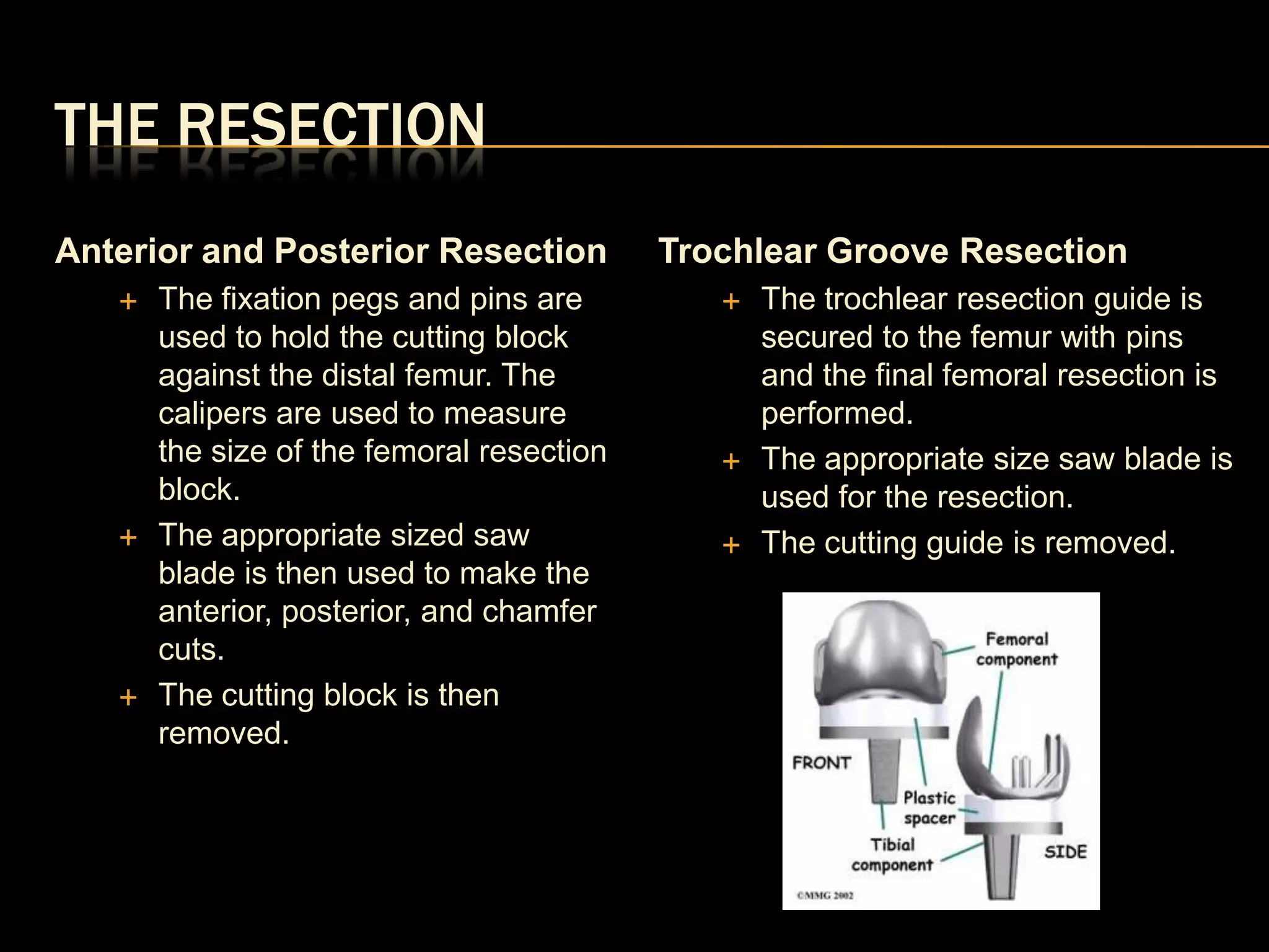 Total Knee Replacement | PPTX