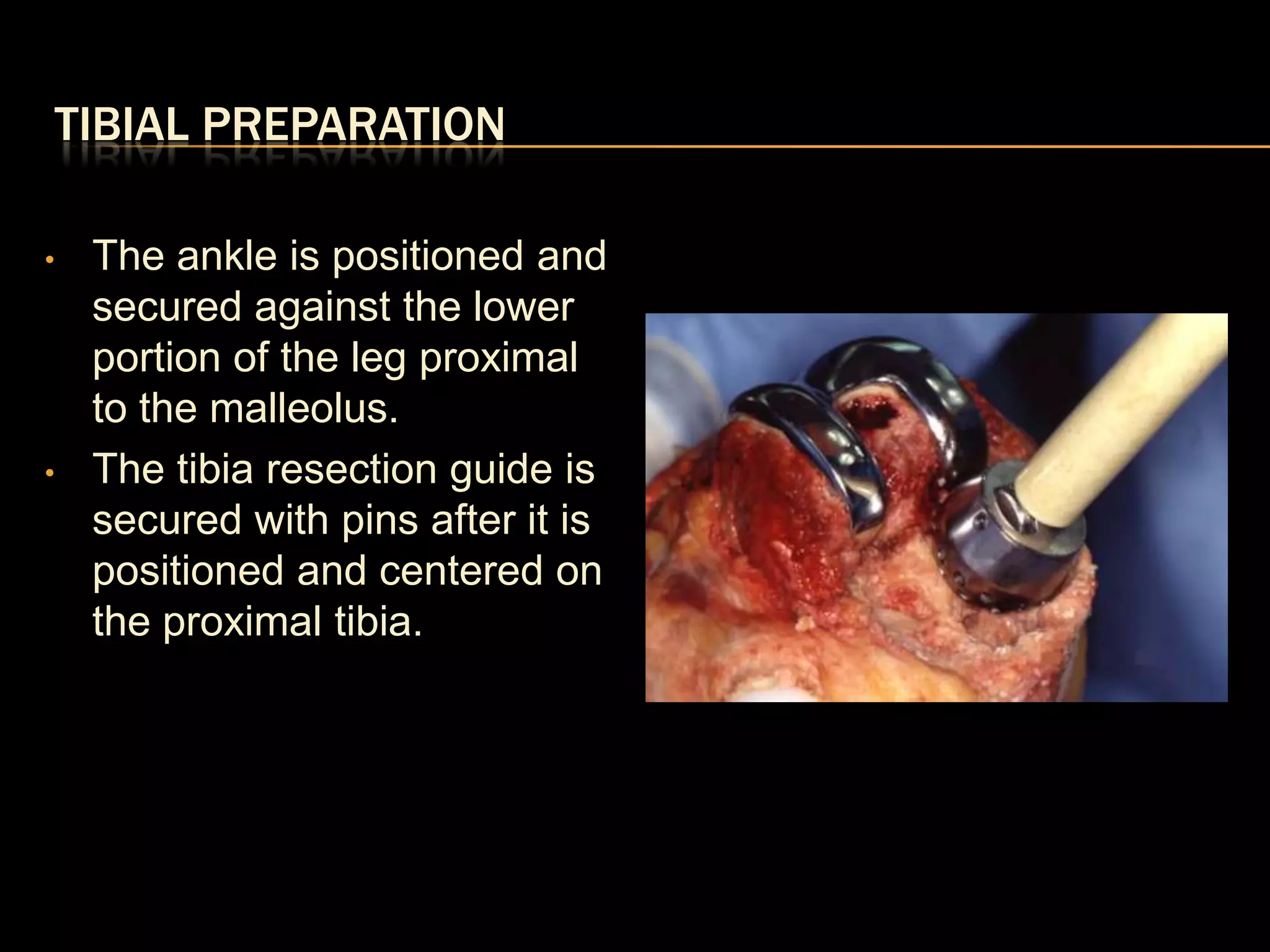 Total Knee Replacement | PPTX
