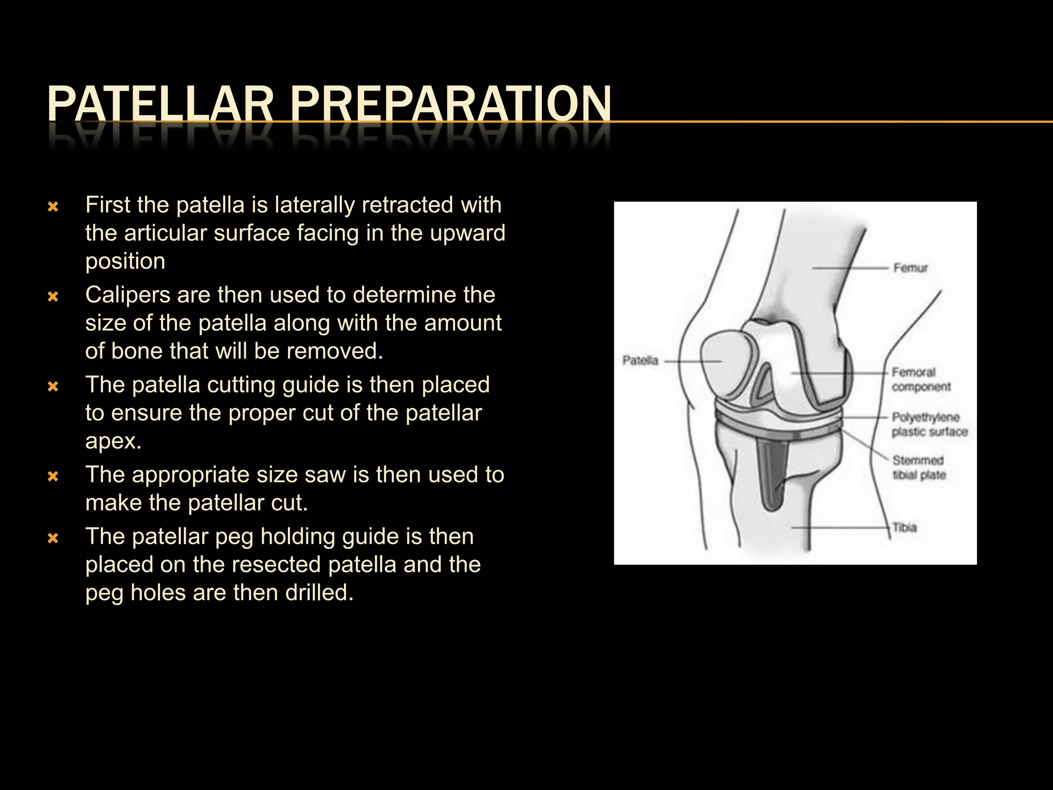Total Knee Replacement | PPTX