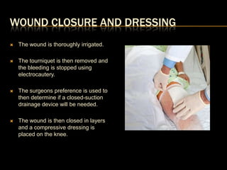 Total Knee Replacement | PPTX