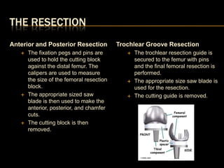 Total Knee Replacement | PPTX