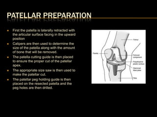 Total Knee Replacement | PPTX