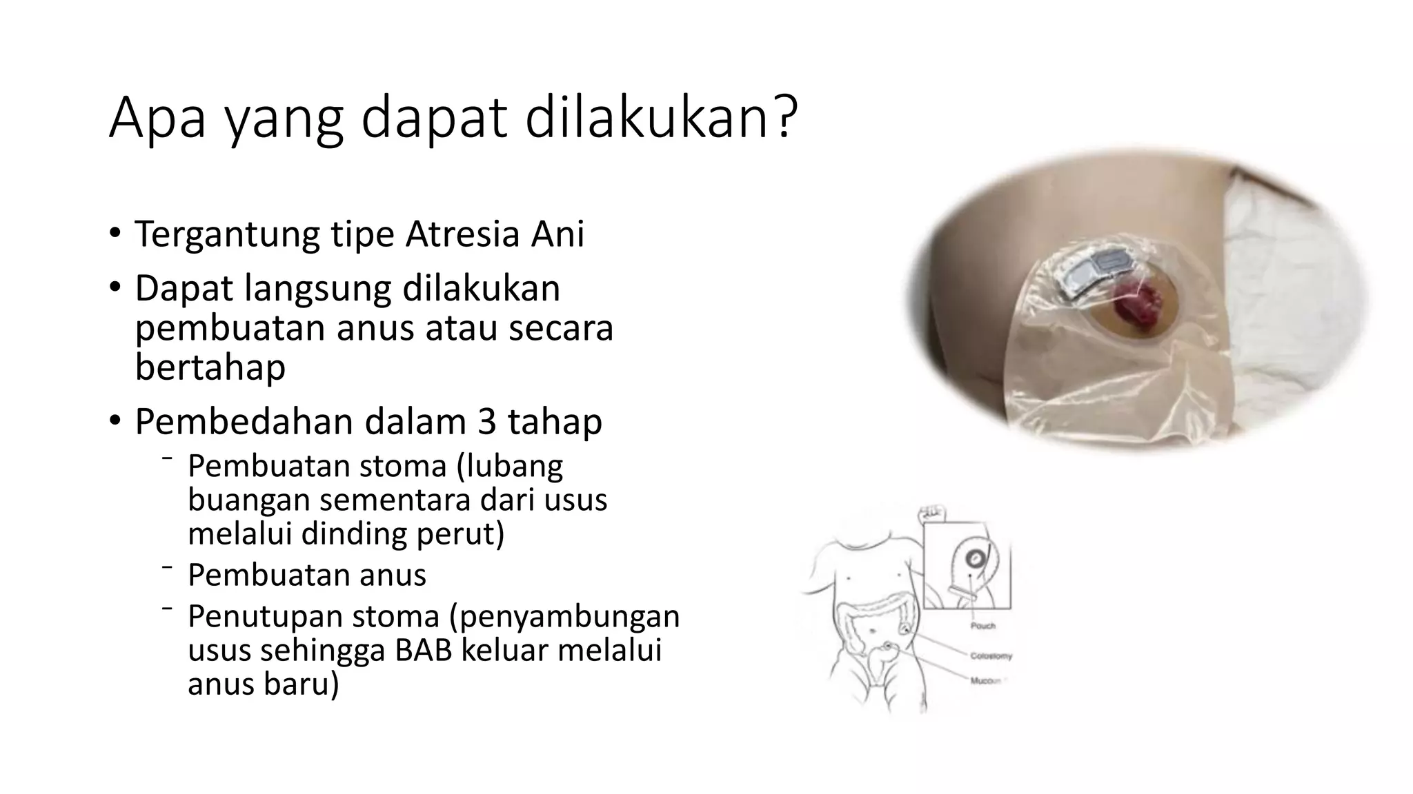 Edukasi_atresia_ani.pptx