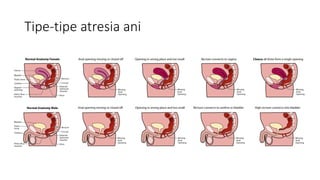 Edukasi_atresia_ani.pptx