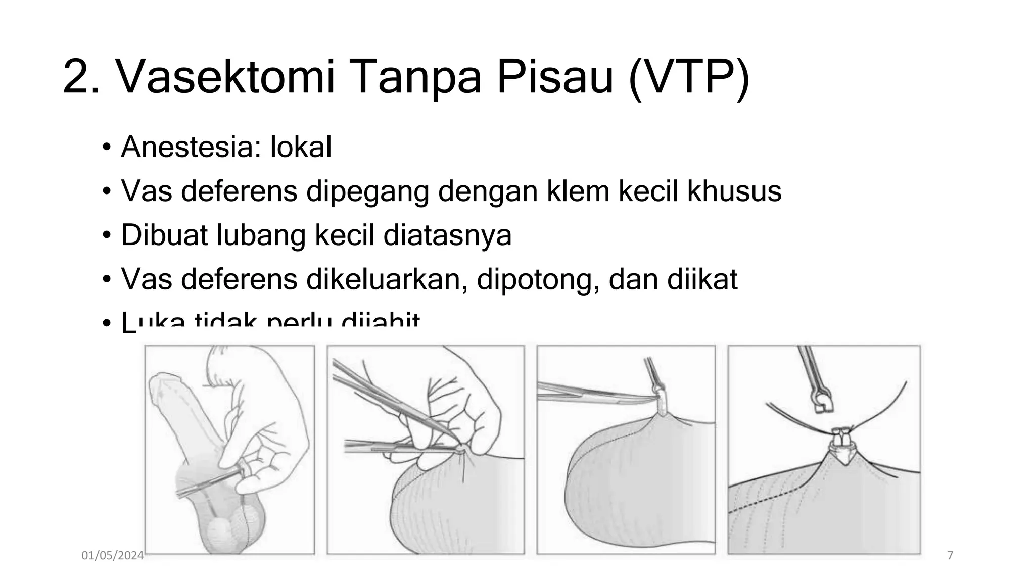 Edukasi Vasektomi dan Non Scalpel Vasectomy.pptx