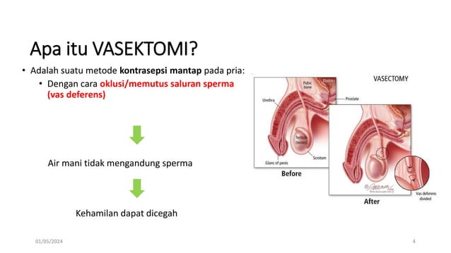 Edukasi Vasektomi dan Non Scalpel Vasectomy.pptx