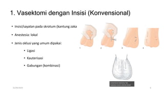 Edukasi Vasektomi dan Non Scalpel Vasectomy.pptx