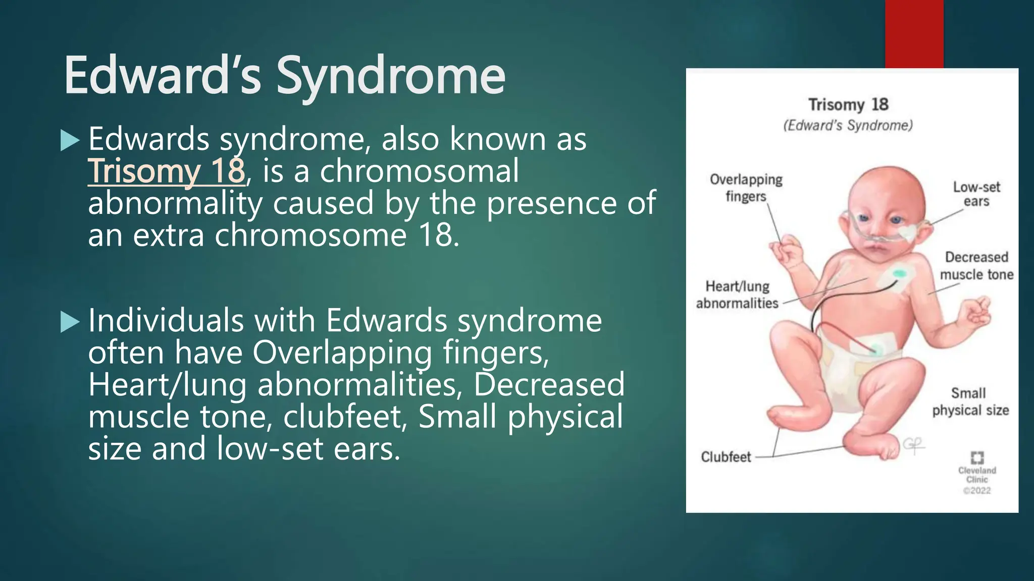 Edwards Syndrome Trisomy 18 Presentation PPTX