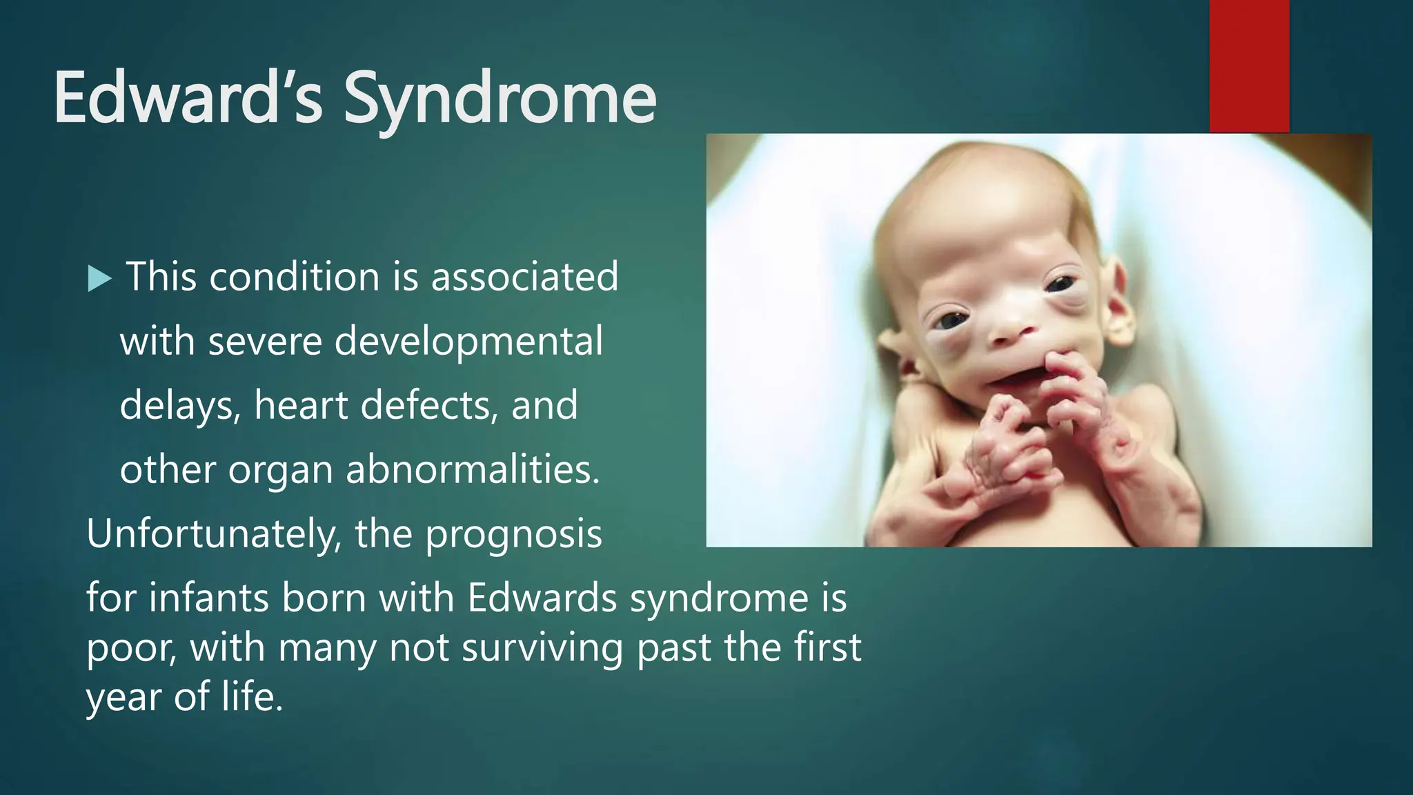 Edwards Syndrome Trisomy 18 Presentation PPTX