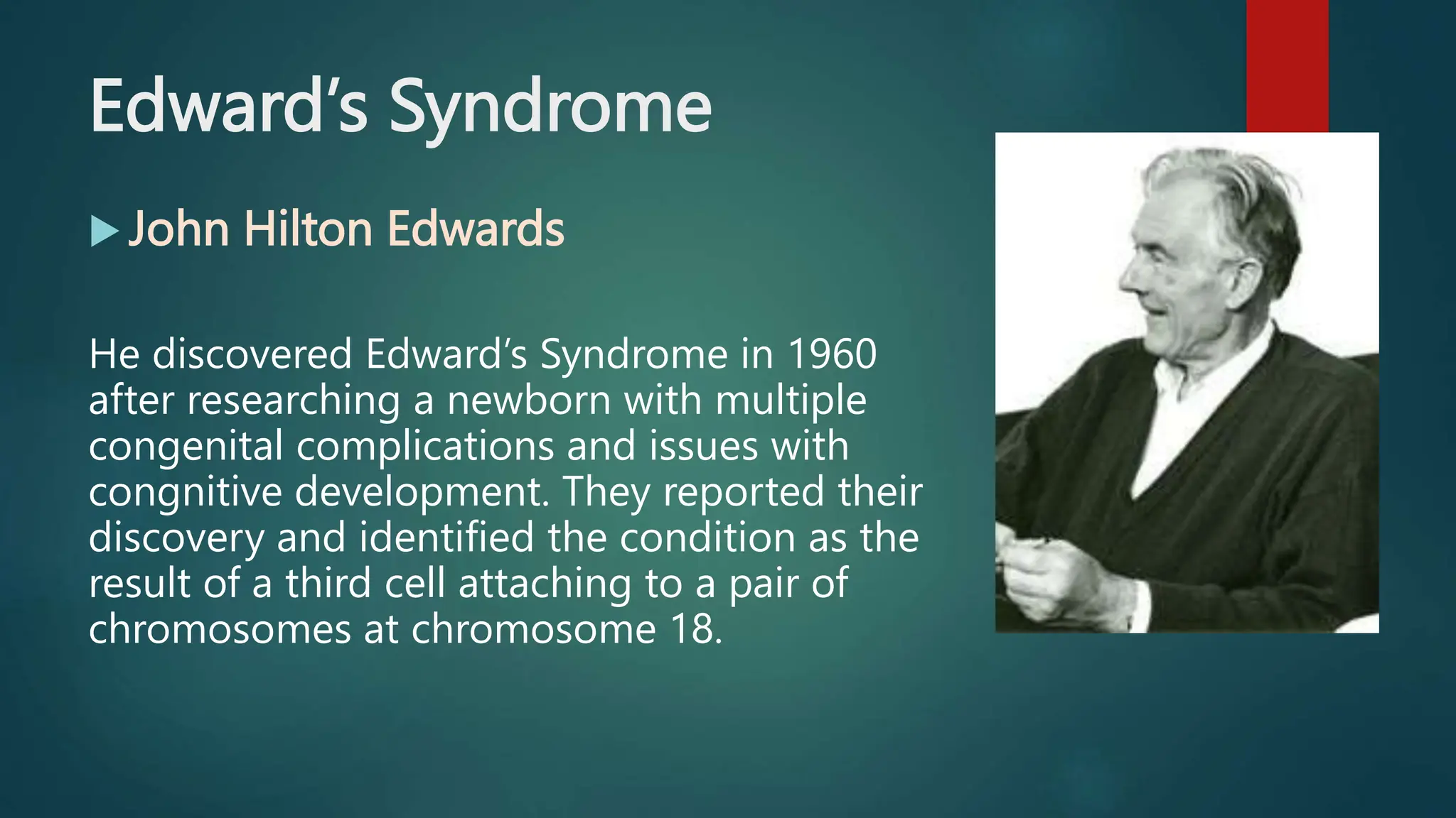 Edwards-Syndrome trisomy 18 presentation | PPTX