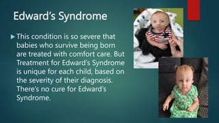 Edwards-Syndrome trisomy 18 presentation | PPTX