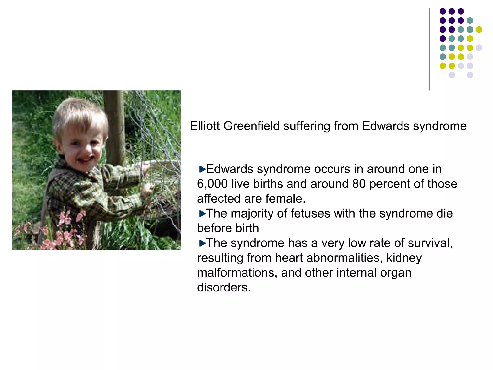 Edward's Syndrome | PPT