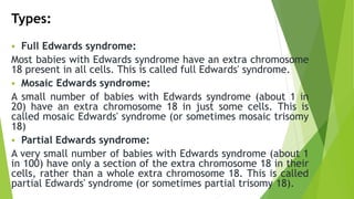 The Presentation on Edwards syndrome.pptx