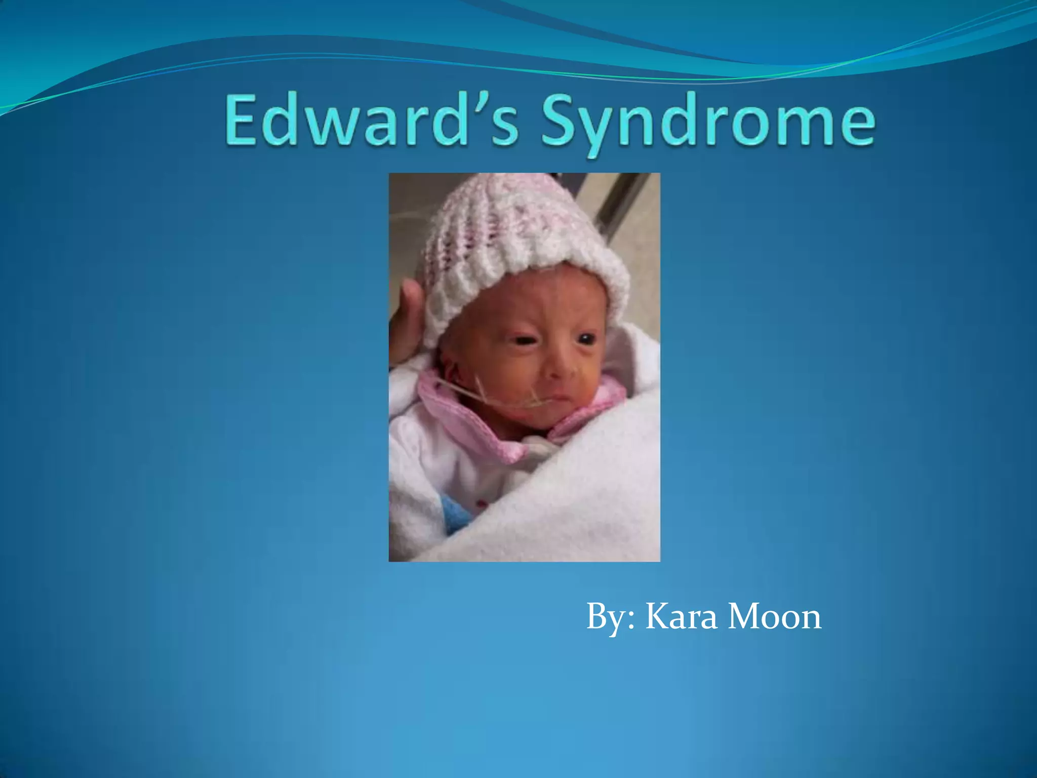 Edward’S Syndrome1 | PPTX