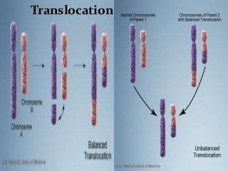 Edward’s syndrome (Trisomy 18) | PPTX