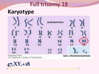 Edward’s syndrome (Trisomy 18) | PPTX
