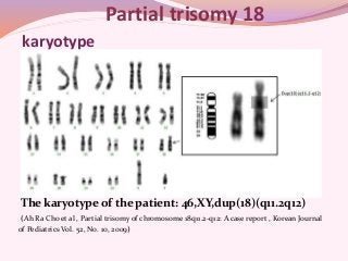 Edward’s syndrome (Trisomy 18) | PPT