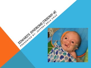 Edward’s syndrome (trisomy 18) | PPTX