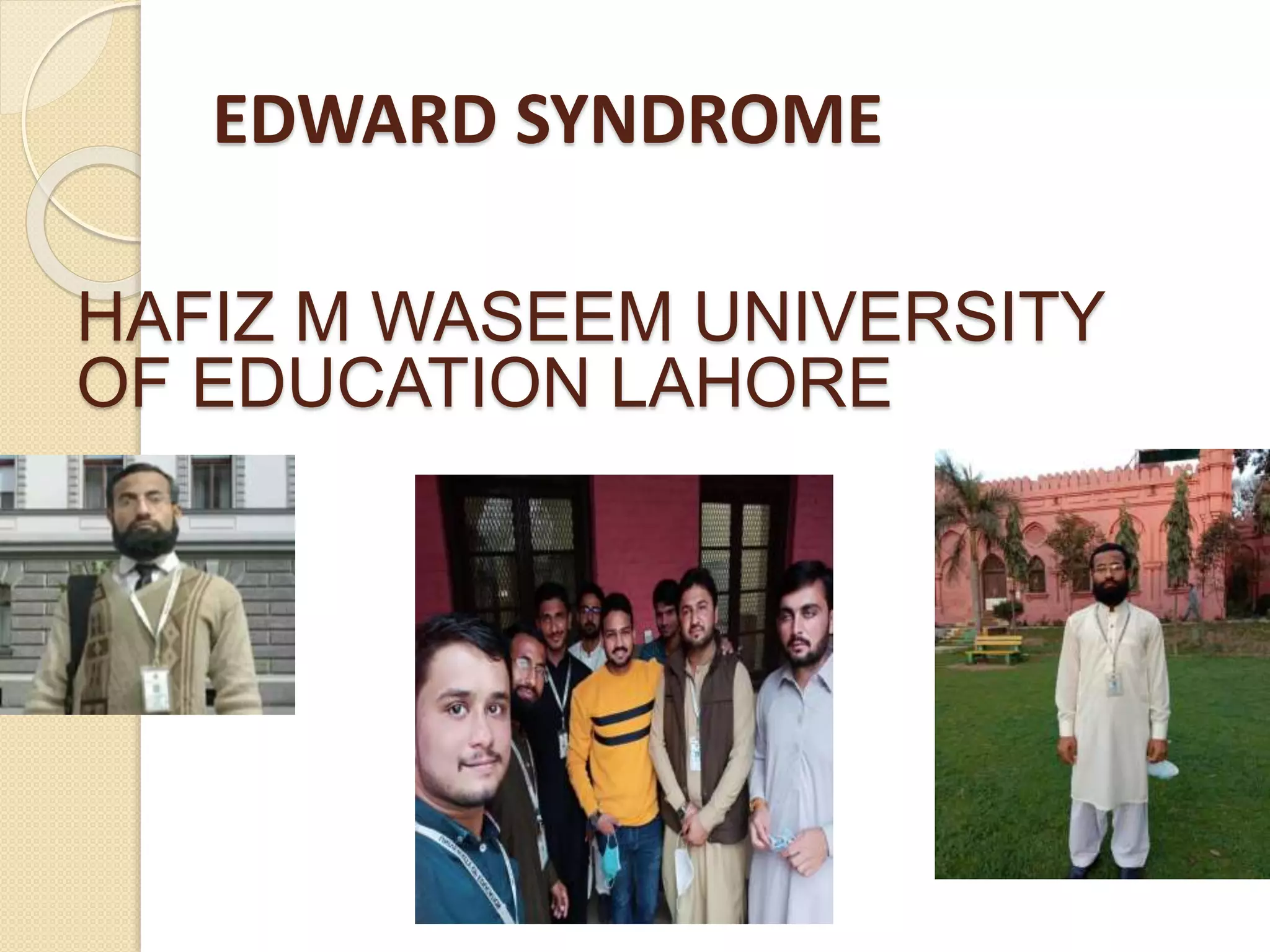 Edward syndrome | PPTX