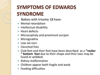 Edward syndrome | PPTX