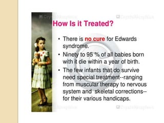 Edward syndrome | PPTX