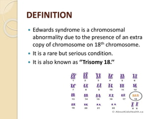 Edward syndrome | PPTX
