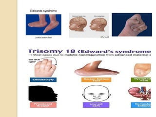 Rocker Bottom Feet Trisomy 18