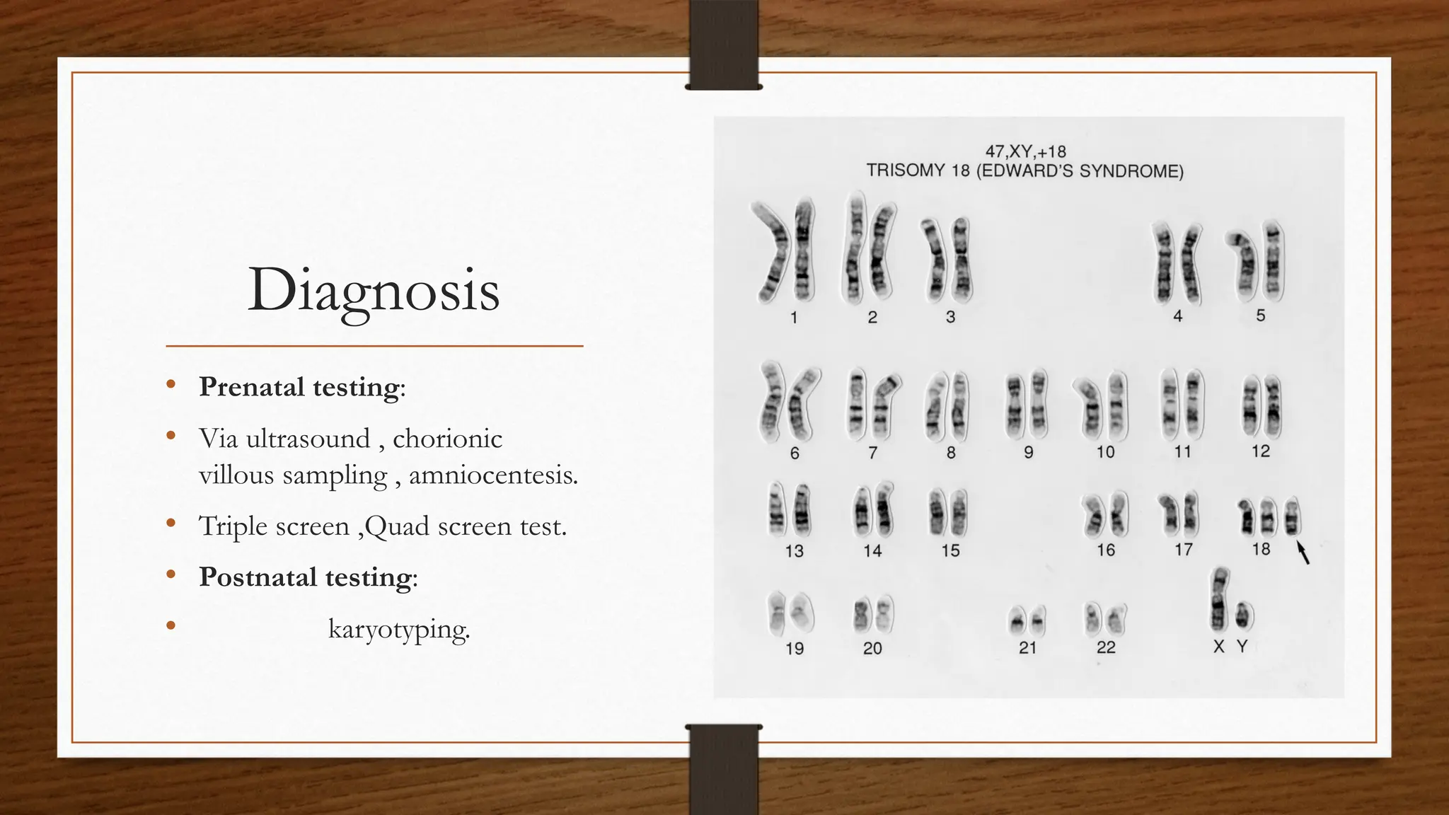Edward syndrome.pdf and ppt by Dr KHANSA | PPTX