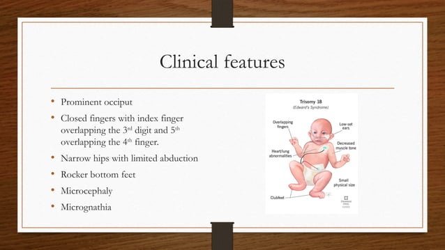 Edward syndrome.pdf and ppt by Dr KHANSA | PPTX