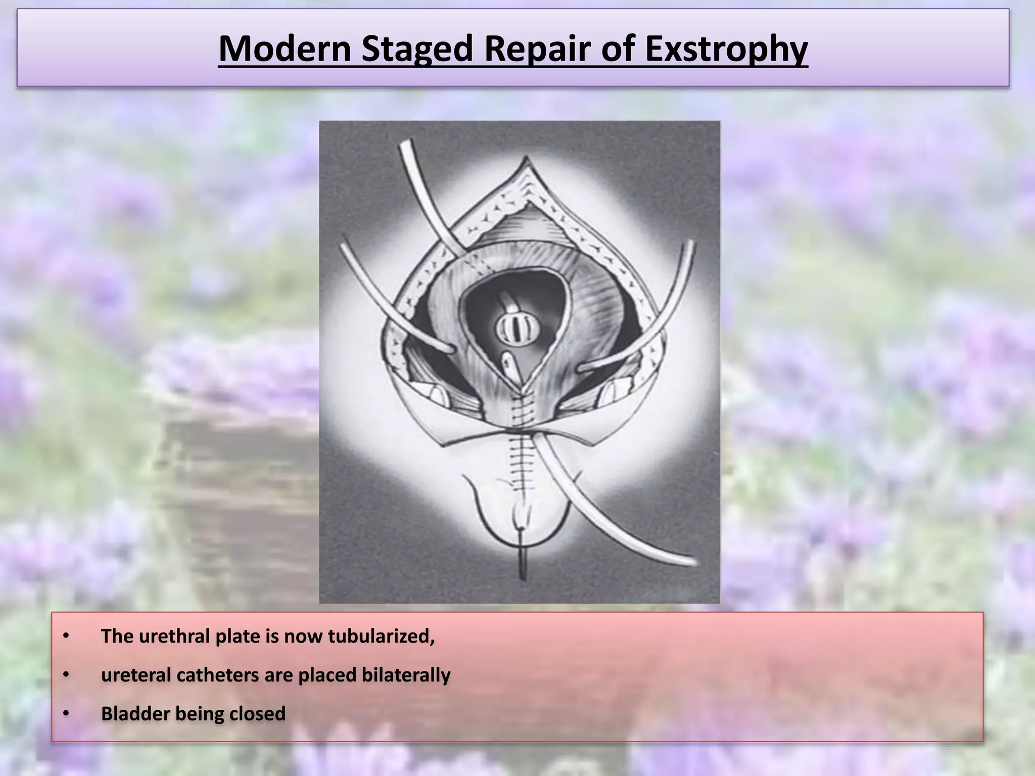 Exstrophy Epispadias Complex MSRE & CPRE | PPTX